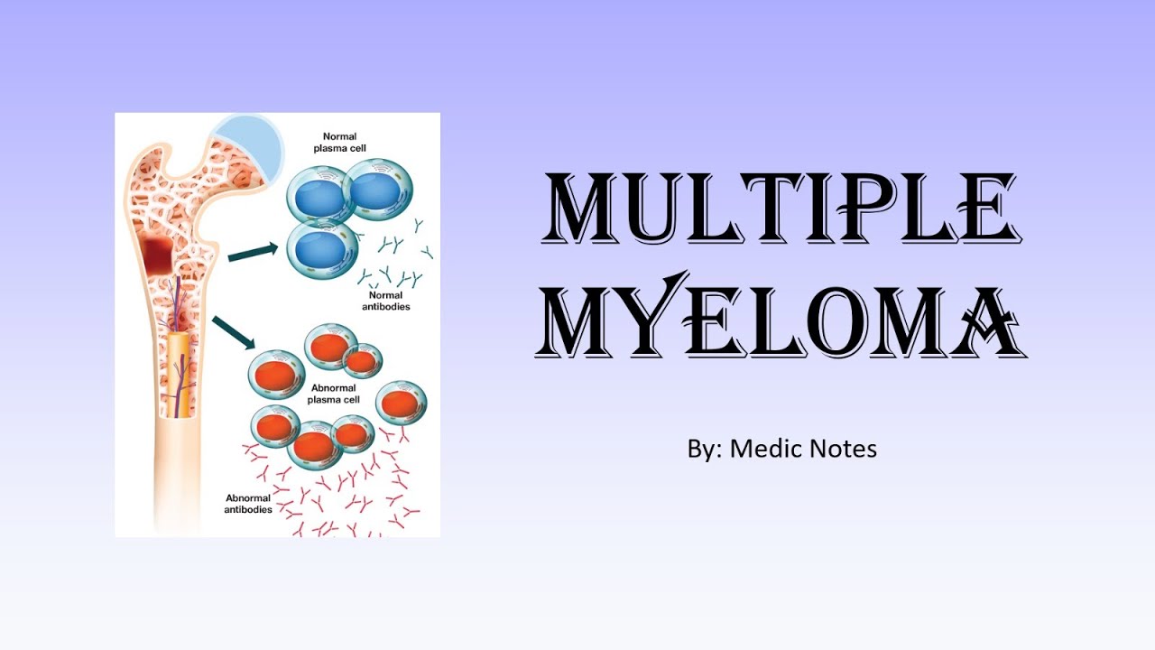 Multiple myeloma - classification, staging, clinical feature ...