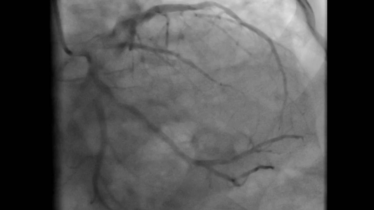 Coronary artery Perforation - Angiogram - YouTube