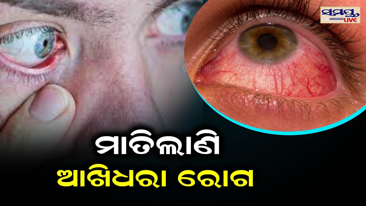 ମାତିଲାଣି ଆଖିଧରା ରୋଗ | eye disease | Odia News Live Updates | Latest ...