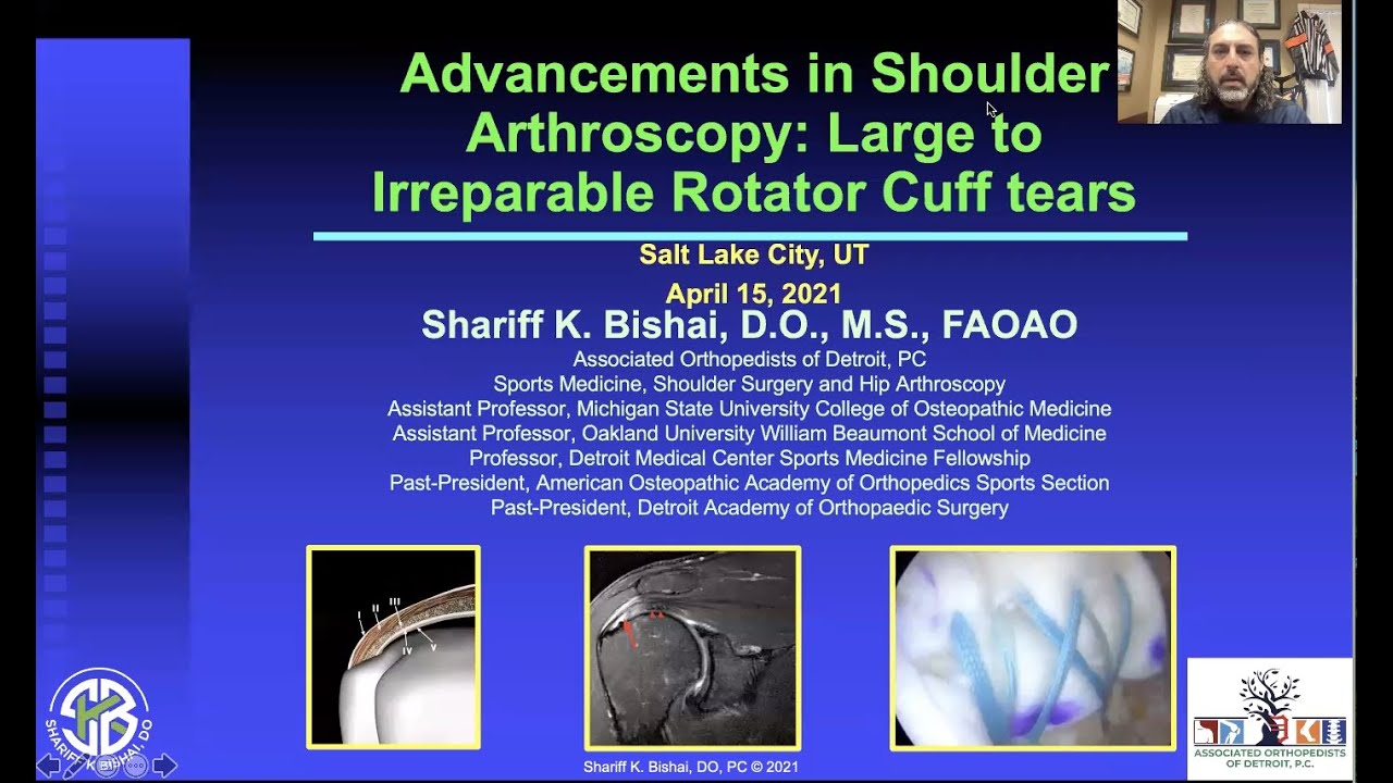 Advancements in Shoulder Arthroscopy: Large to Irreparable Rotator Cuff ...