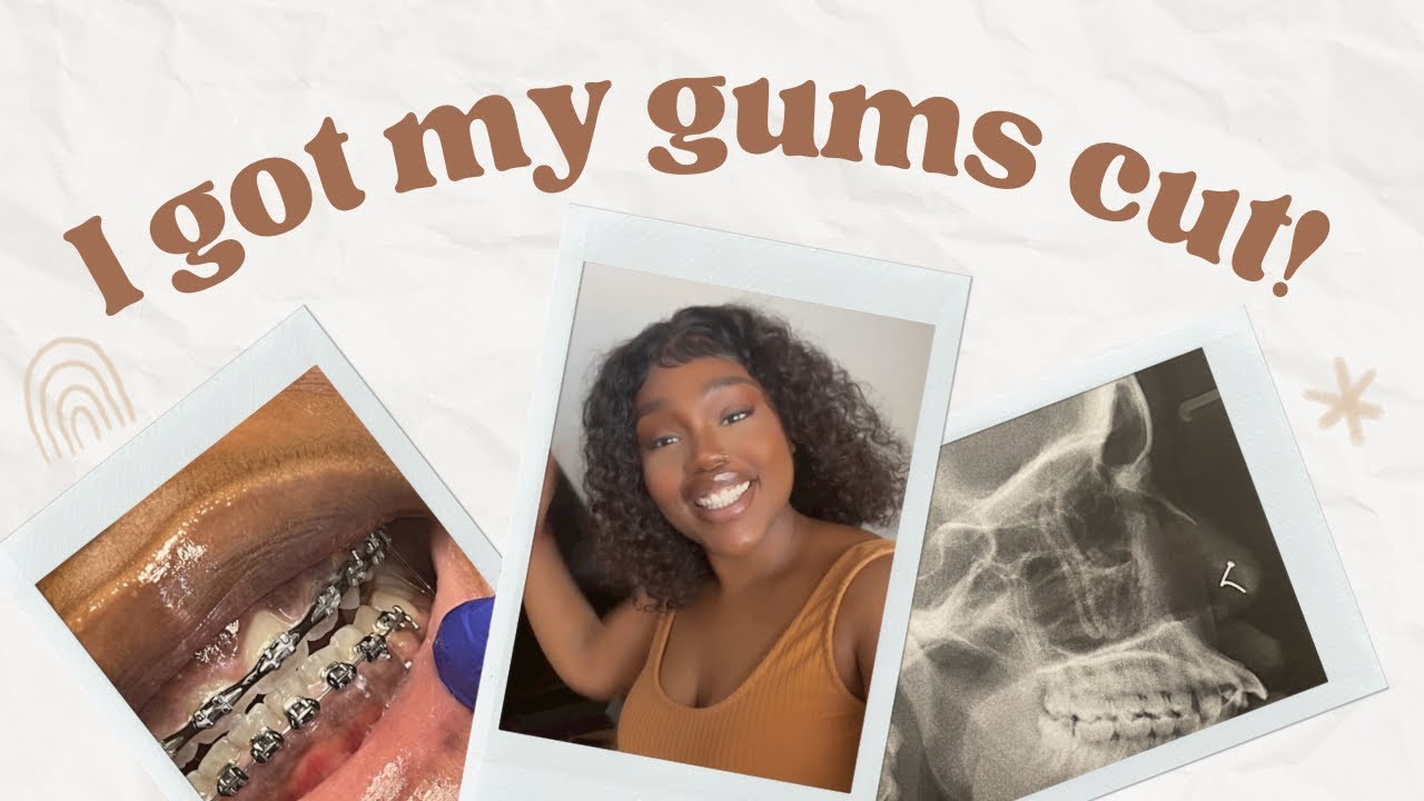 COME W/ ME TO GET MY GUMS CUT AND BRACES REMOVED! | recovery | Dyemond ...