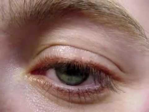 Vertical Nystagmus- possible PCP use - YouTube