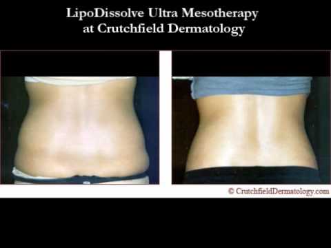 LipoDissolve Ultra Crutchfield Dermatology Eagan, Minnesota - YouTube