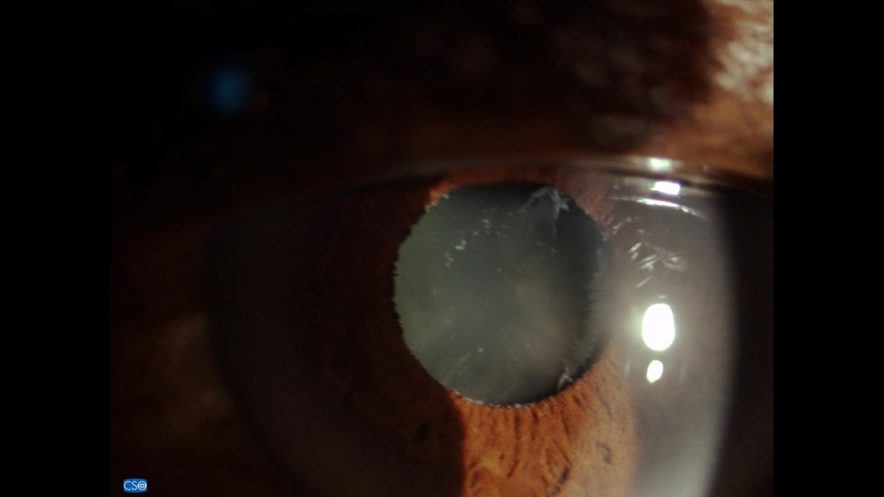 Pseudoexfoliation, narrow pupil, full - YouTube