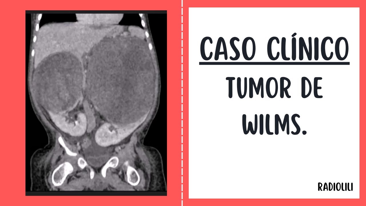 Caso Clínico 91: Tumor de Wilms. - YouTube