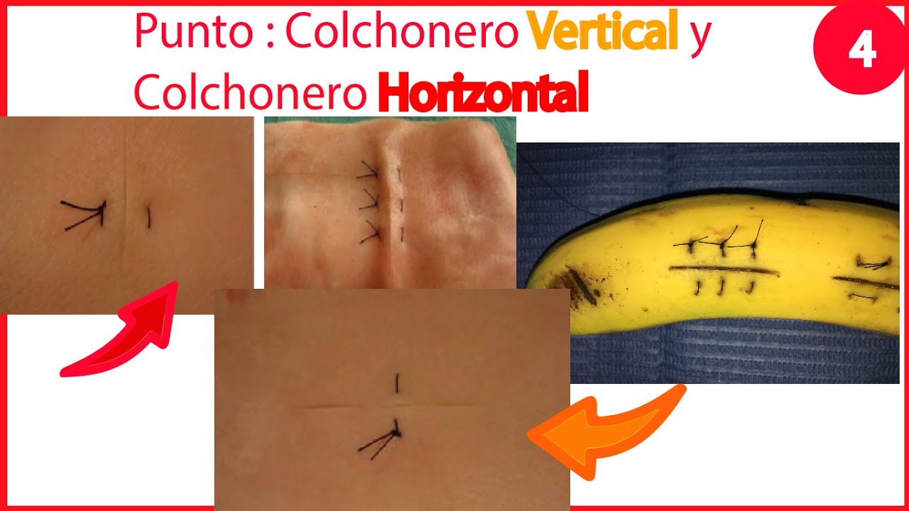 Técnica de Sutura : Colchonero Vertical y Colchonero Horizontal ...