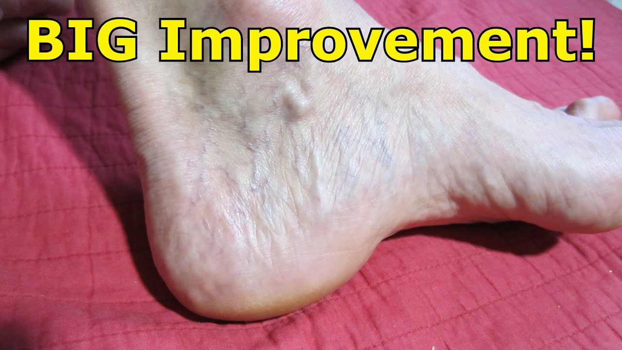 Veins in Your Feet Bulging, Popping Out on Inside. Varicose Veins. Poor ...