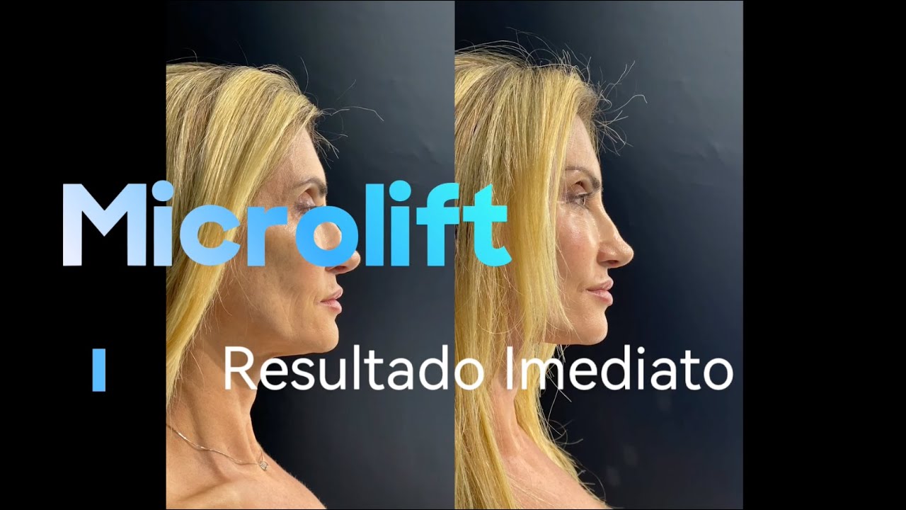 Microlift Facial - YouTube