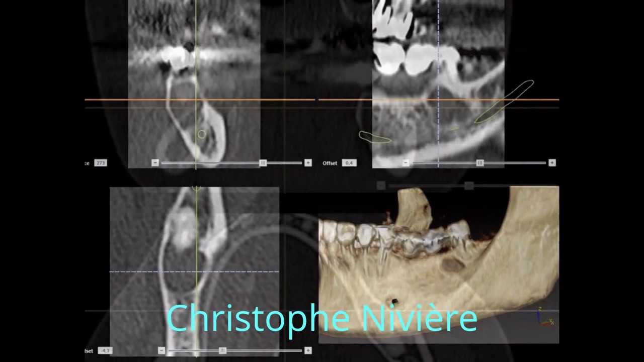 Kyste d'origine dentaire - YouTube