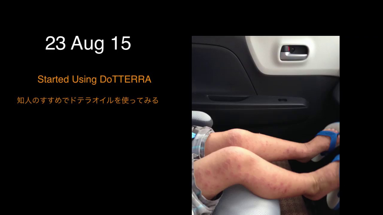 NAET Treatment Report - YouTube