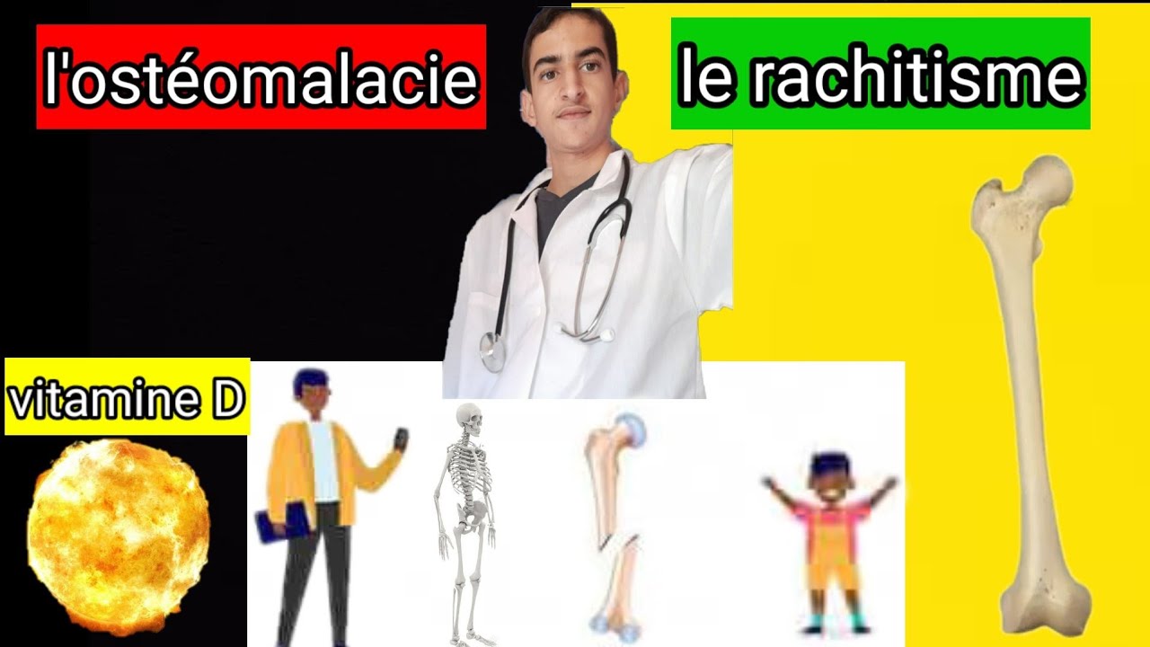le rachitisme et l'ostéomalacie - YouTube