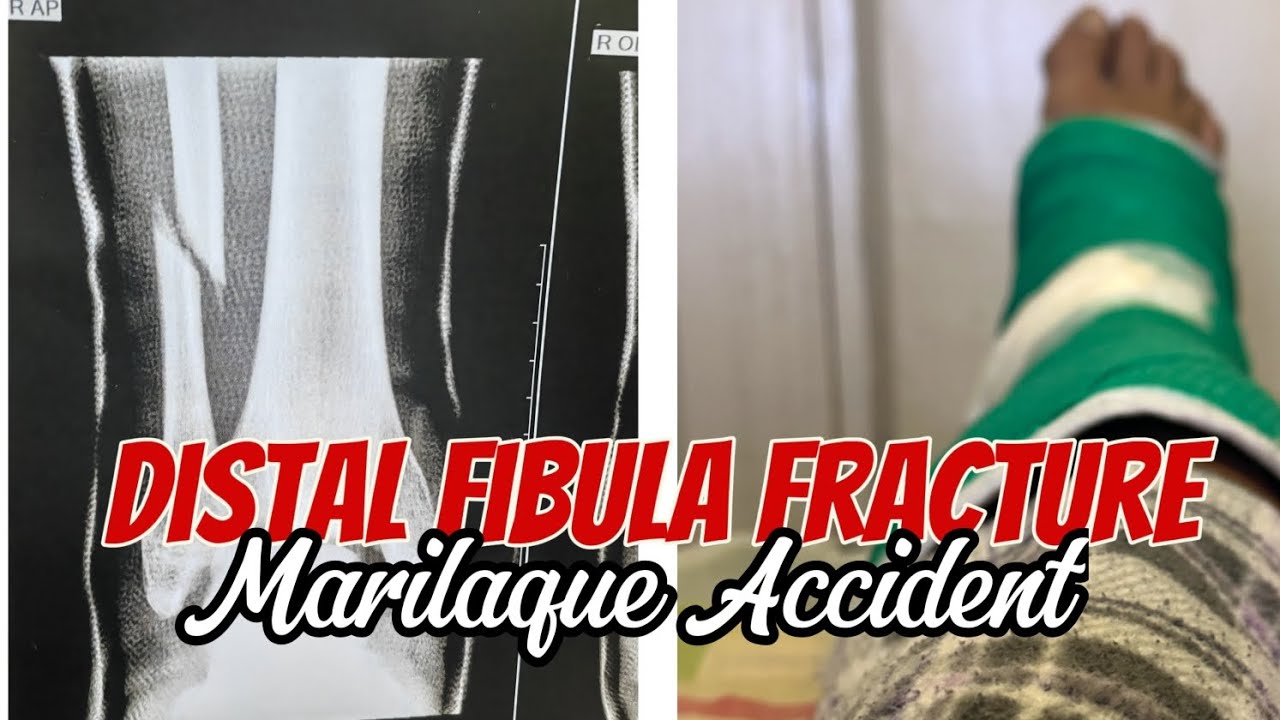 Distal Fibula Fracture Healing Journey - Marilaque Accident on big bike ...