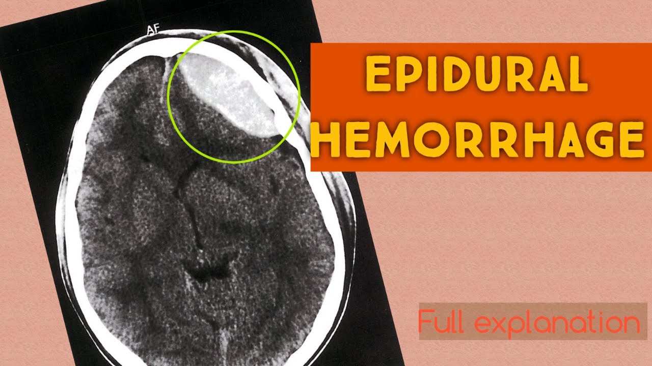 Epidural Hemorrhage Radiology (Epidural Hematoma) - YouTube