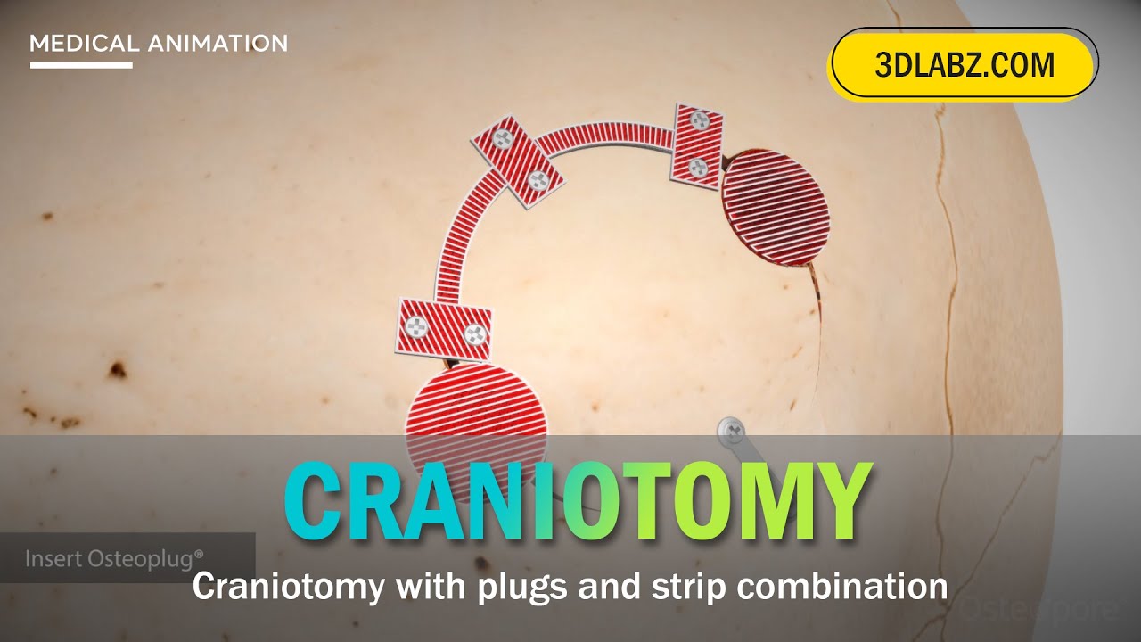 Craniotomy Brain Surgery 3D Animation | Neuro Surgery - YouTube