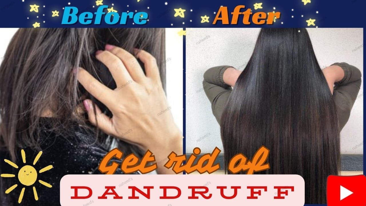 Get rid of Dandruff | Long Hair Tips | DO THIS 1x a Month For ...