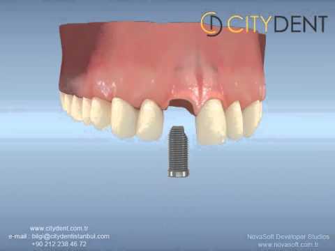 diş çekimi sonrası implant uygulanması