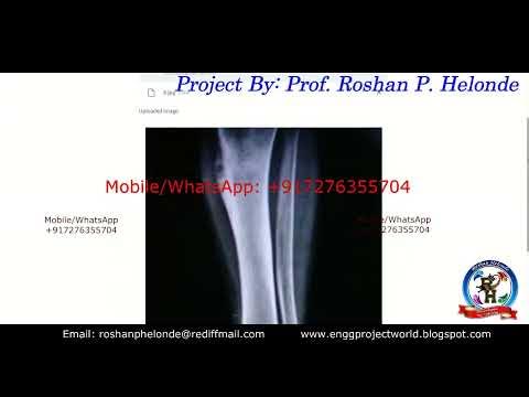 Bone Fracture Detection Using Image Processing With Source Code | Python Project Fracture ...
