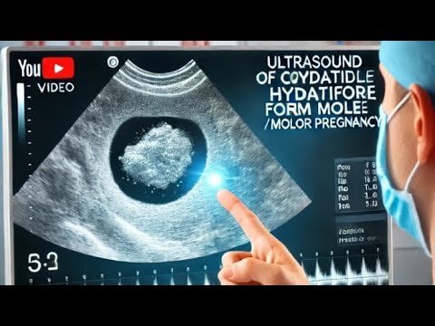 Ultrasound Findings in Complete Hydatidiform Mole | Molar Pregnancy ...