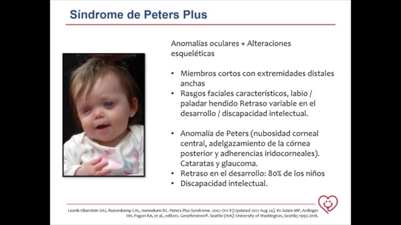 Caso clínico Octubre: Síndrome dismórfico cuando es más de una anomalía ...