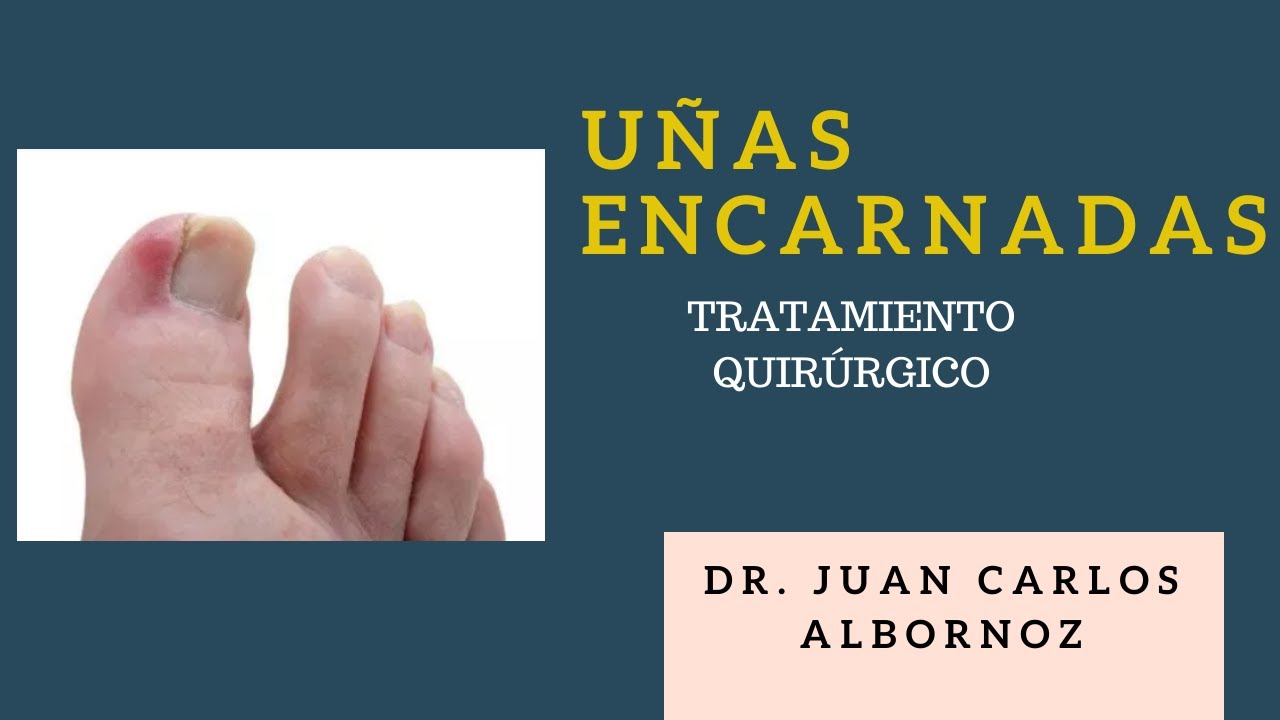 UÑA ENCARNADA : ¿CÓMO SE OPERA SIN DOLOR? - YouTube