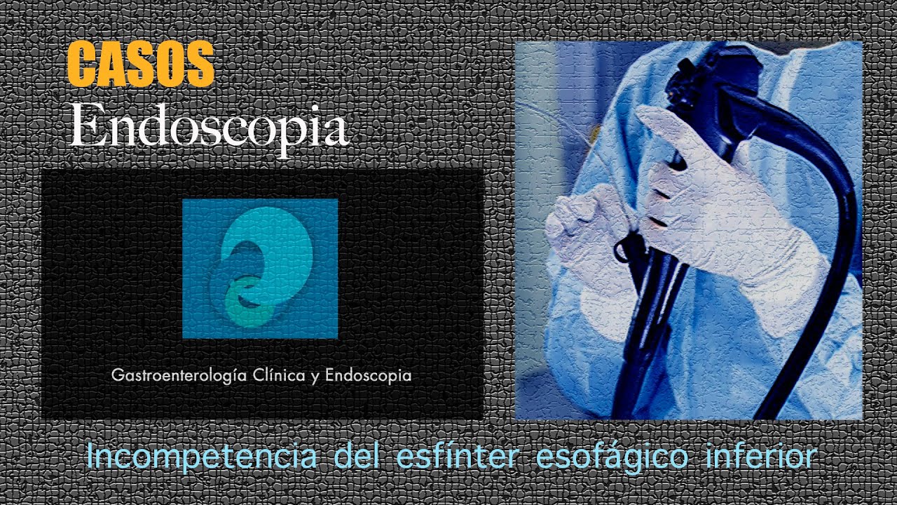 Incompetencia del Esfínter Esofágico Inferior - YouTube