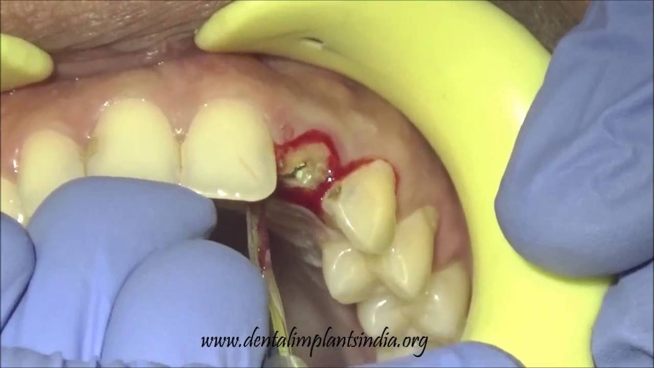 Upper Lateral incisor extraction and immediate basal implant with ...