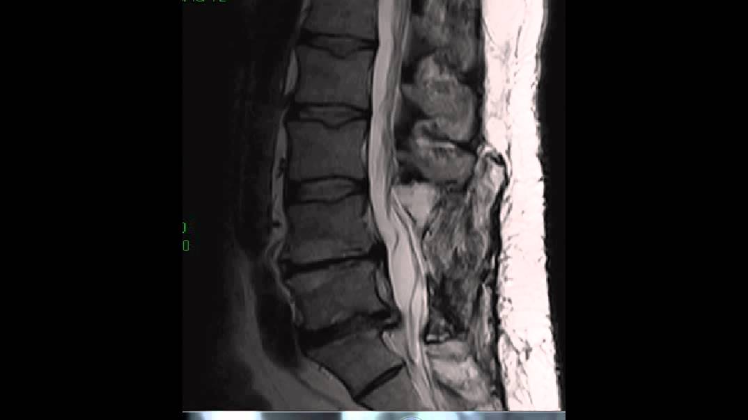 Lumber Degenerate disc disease MRI scan. - YouTube