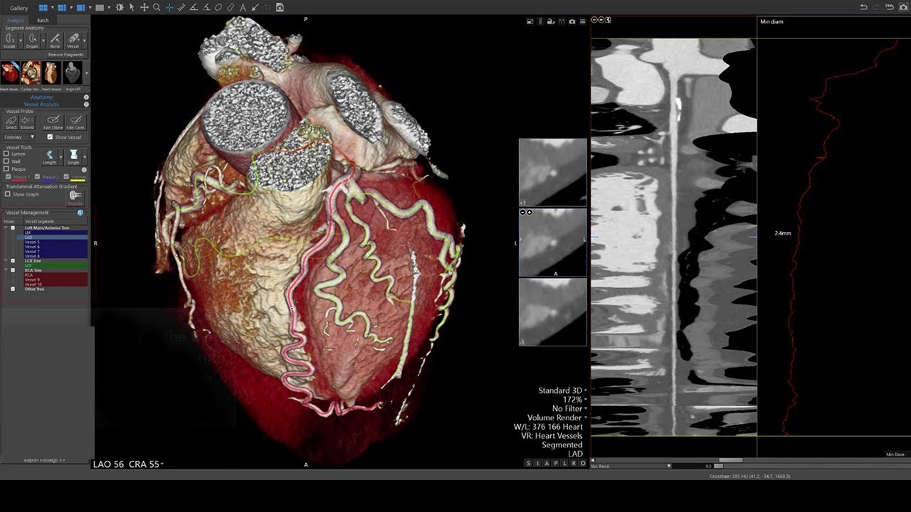 Ct Cardiac Anatomy