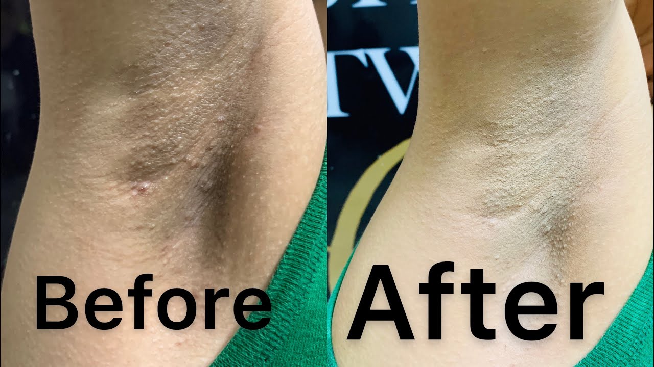 Home Remedy For Remove Pigmented Underarms By Classy Beauty Care ...