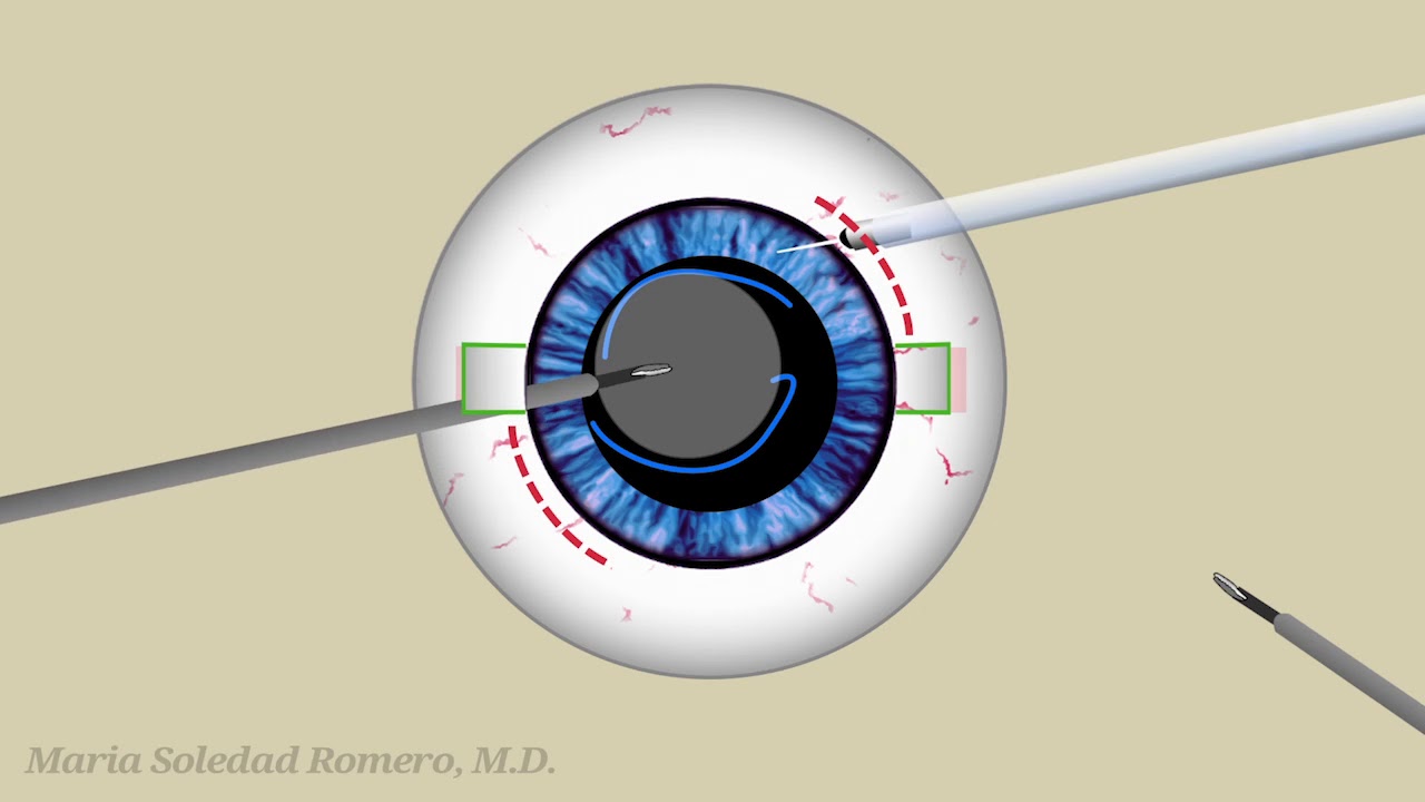 Glued IOL technique - animation with Steps - YouTube