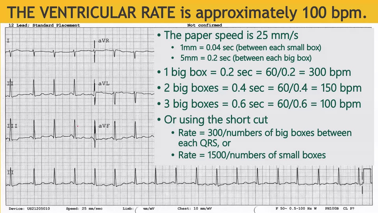 Basic ECG Interpretation 2/9: Rate - YouTube