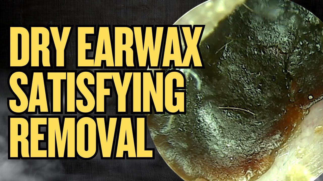 DRY EARWAX Satisfying Removal - YouTube