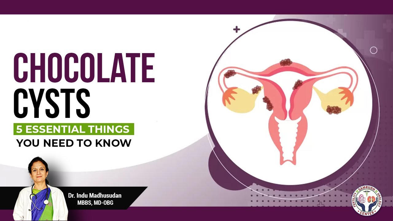 Chocolate Cysts : 5 Essential Things you need to Know! - YouTube