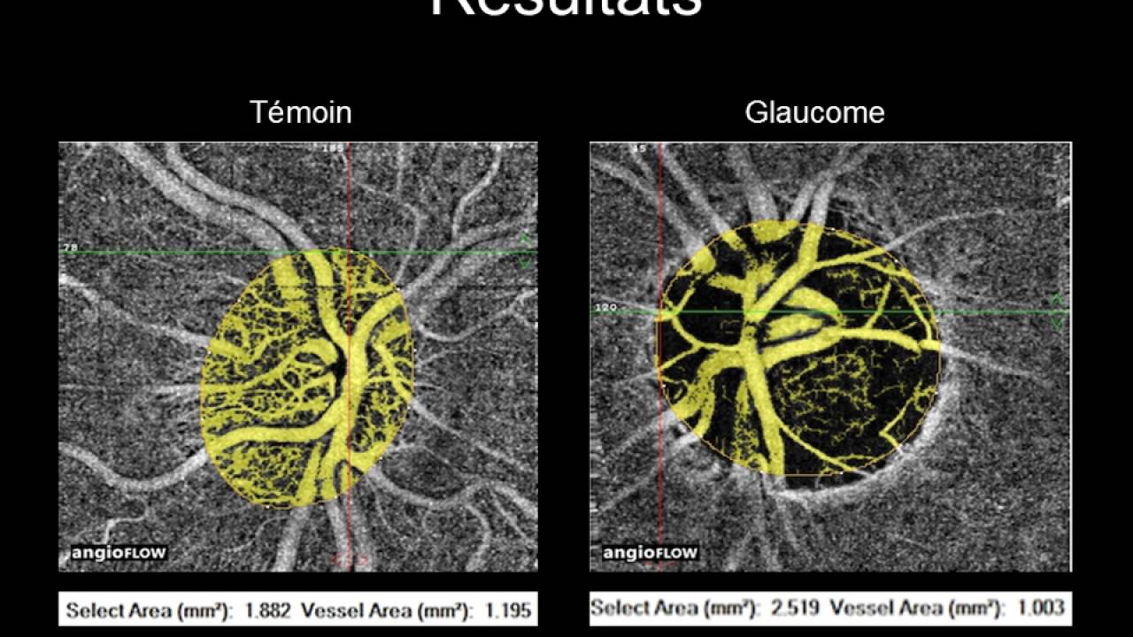 Vascularisation de la tête du nerf optique (Pierre-Maxime Leveque ...