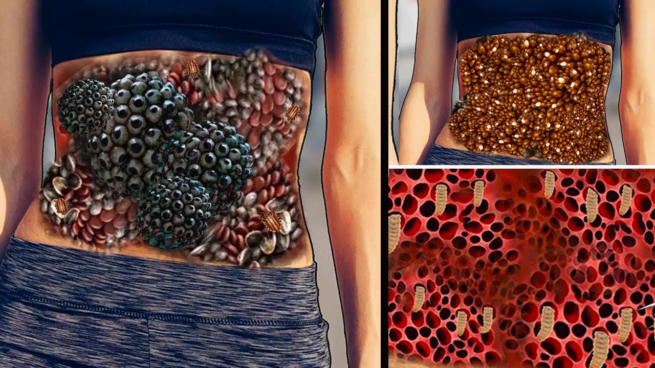 ASMR Cleaning of Maggot from infected Girl belly|ASMR Treatment ...