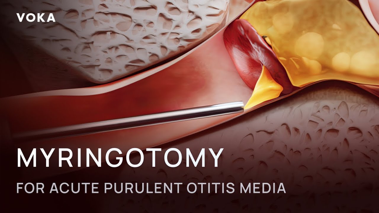 Myringotomy for Acute Purulent Otitis Media | VOKA 3D animation - YouTube
