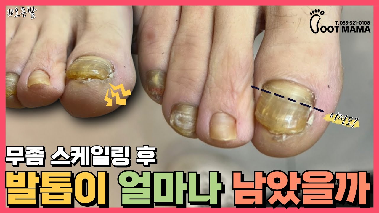 무좀 스케일링 후 남은 발톱은 얼마나될까? -athlete's foot toenail scaling - YouTube