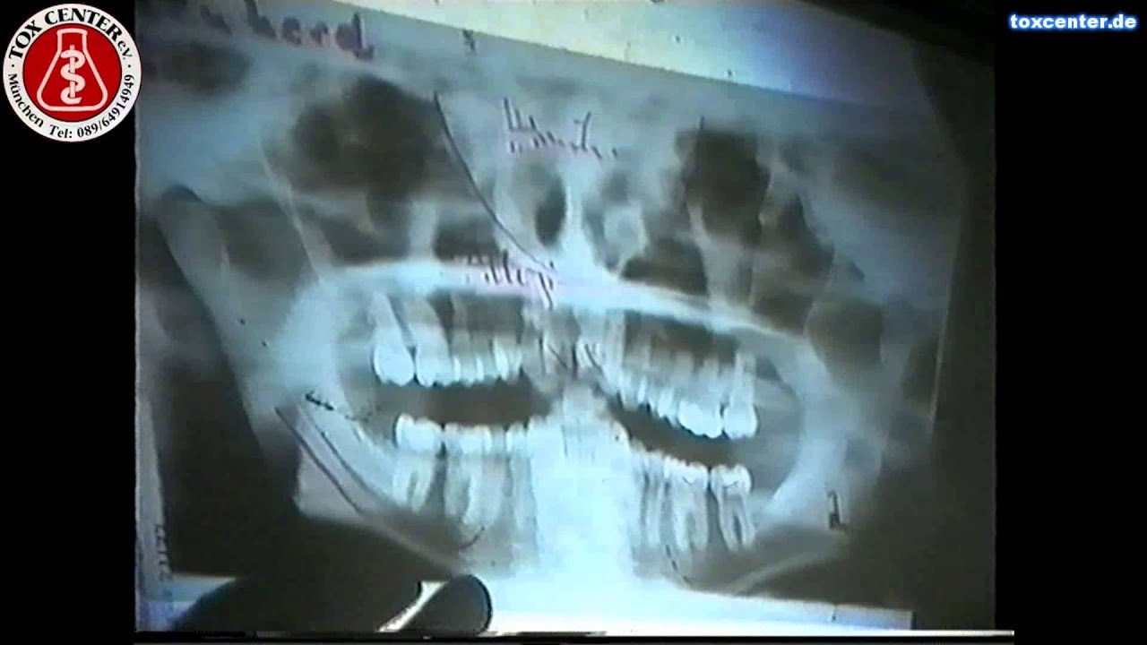 Das vergiftete Kind - (21/22) Vortrag Dr. Daunderer - YouTube