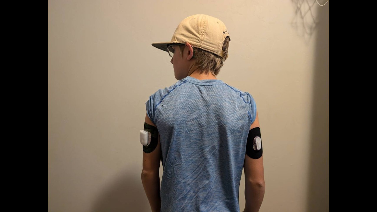 Inserting Omnipod 5 Insulin Pump & Dexcom G6 in Arms of 10 Year Old for ...