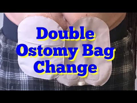 Double Ostomy bag change... - YouTube