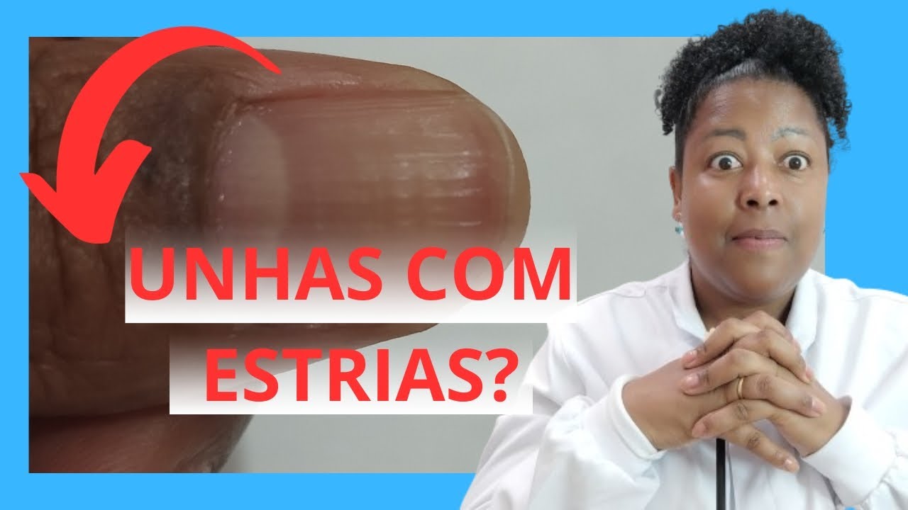 UNHAS COM ESTRIAS SAIBA O QUE FAZER. - YouTube