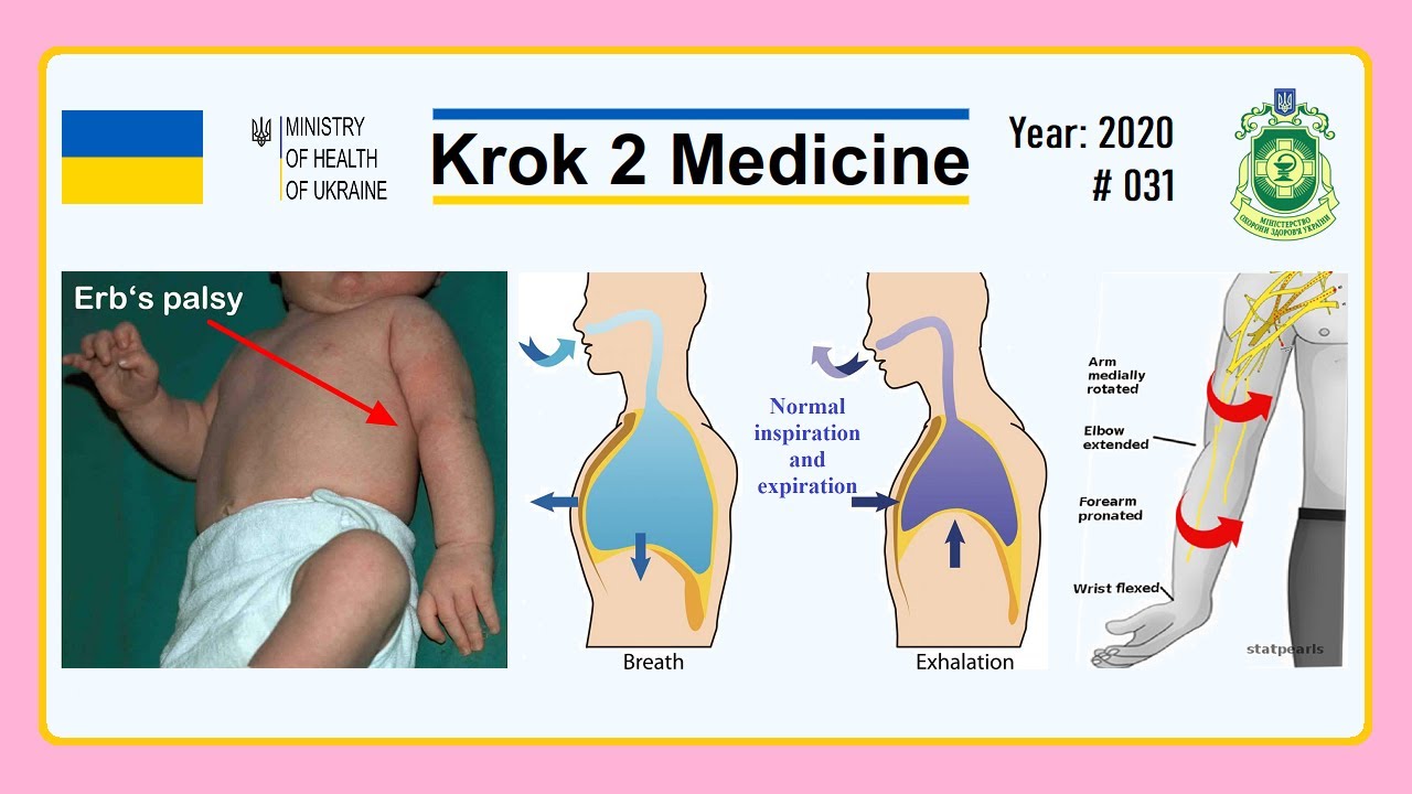 [ Krok 2 Medicine ] Year: 2020 - 031 (Ministry of Public Health of ...