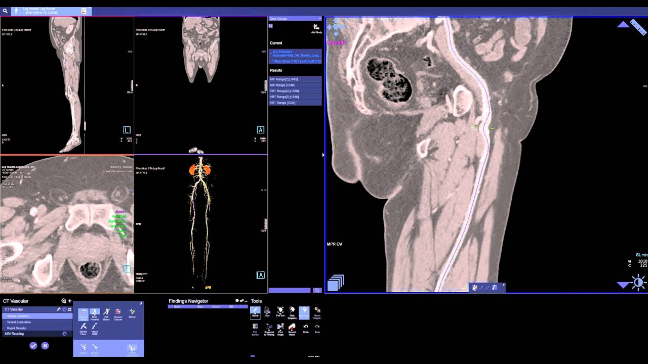 CTA Leg Runoff Workup Performed on a Siemens Syngo Via - YouTube