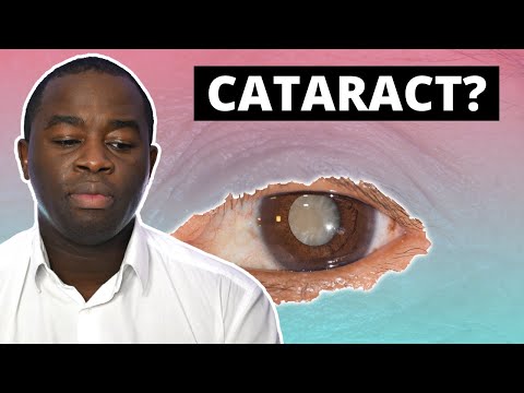 Cataracts: Everything You Need To Know!