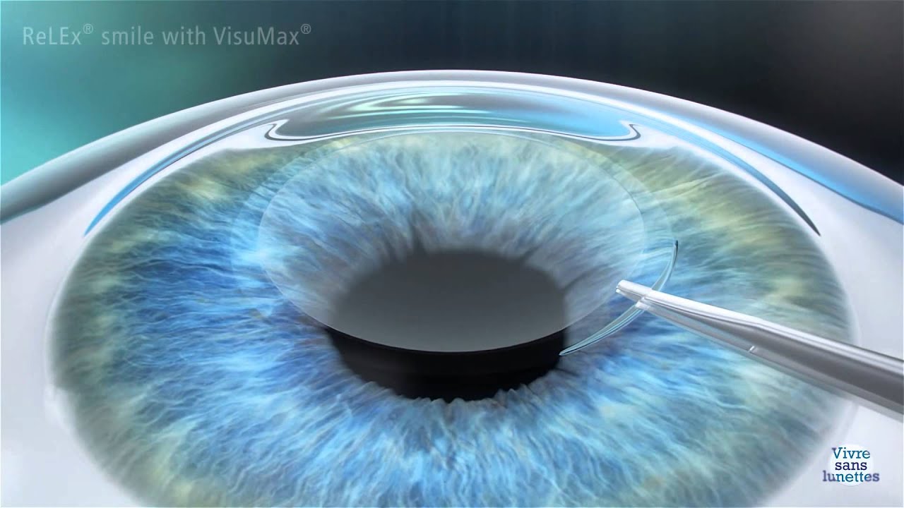 RELEX SMILE - Nouveau style d'opération des yeux par laser au Maroc ...