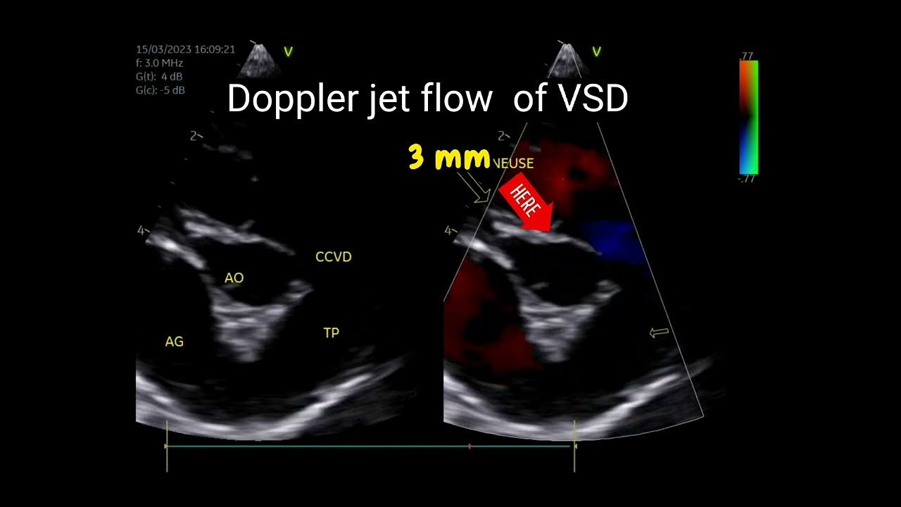 perimembranous VSD in 7 month-old dog 🐶 - YouTube