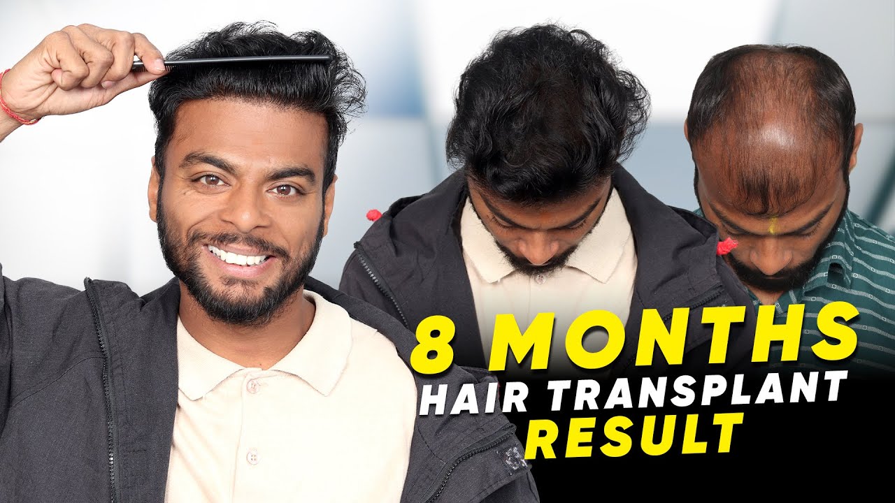 Hair Transplant in Hubli | Best Results & Cost of Hair Transplant in ...