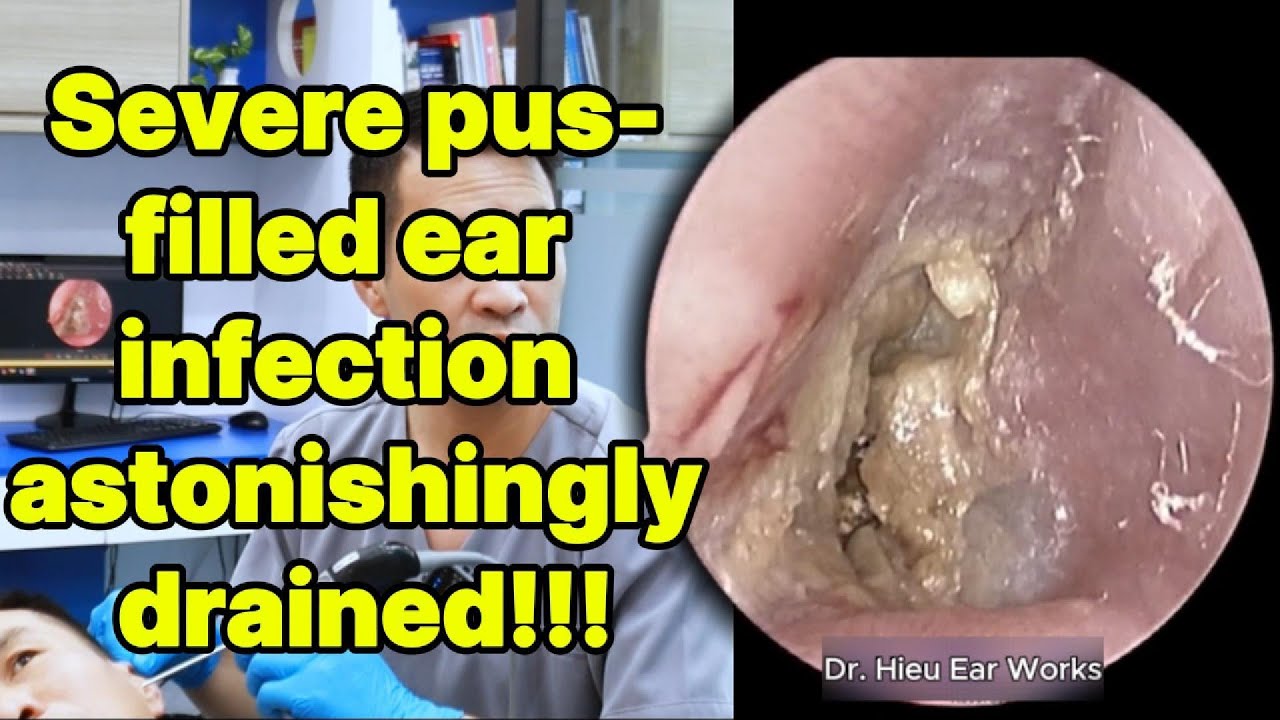 Severe pus filled ear infection astonishingly drai | ear cleaning ...