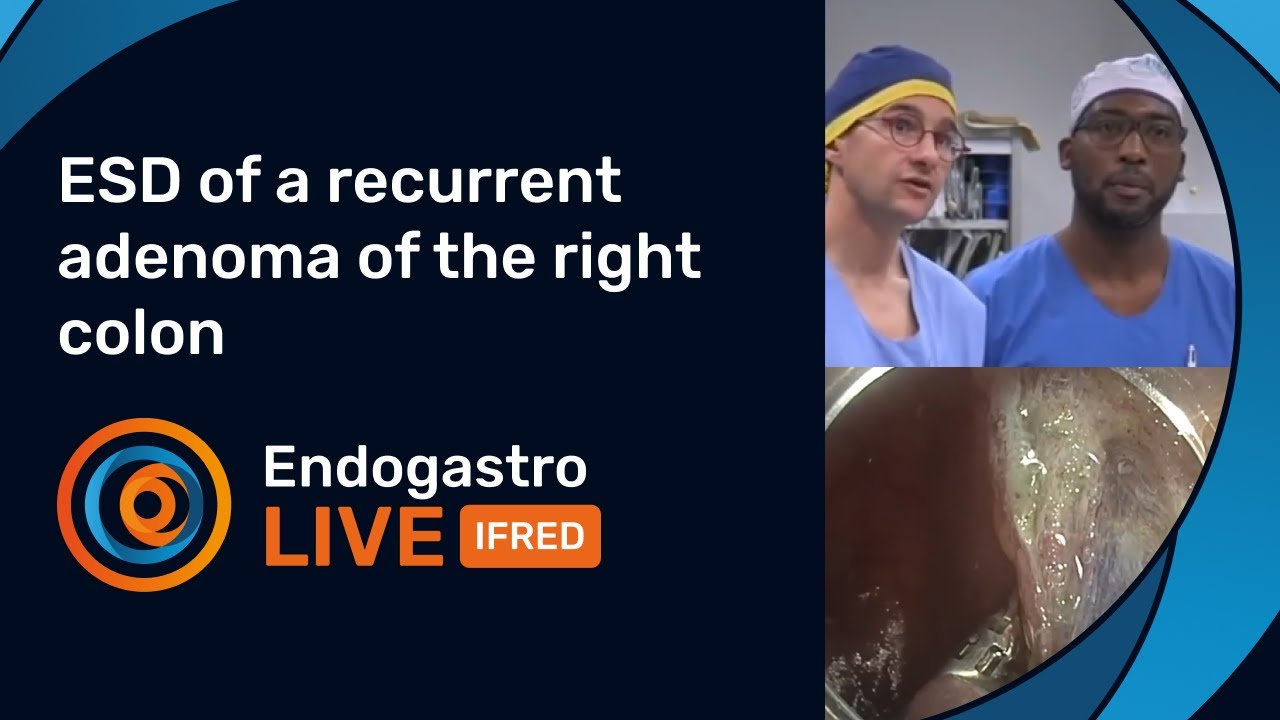 ESD of a recurrent adenoma of the right colon - YouTube
