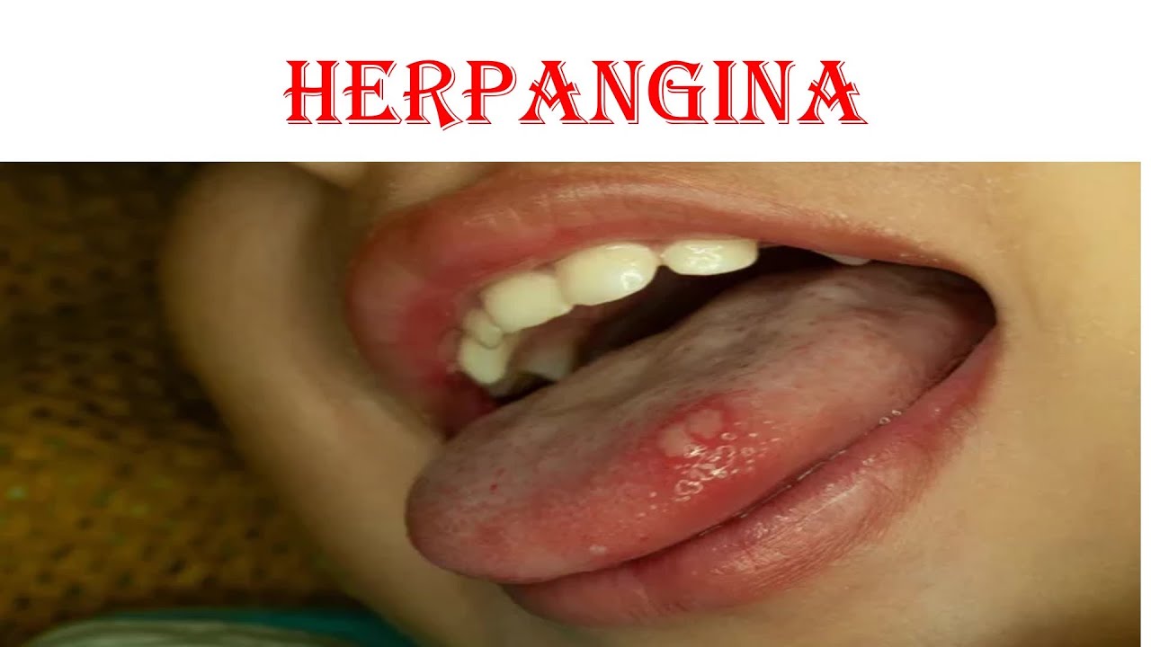 Herpangina Youtube